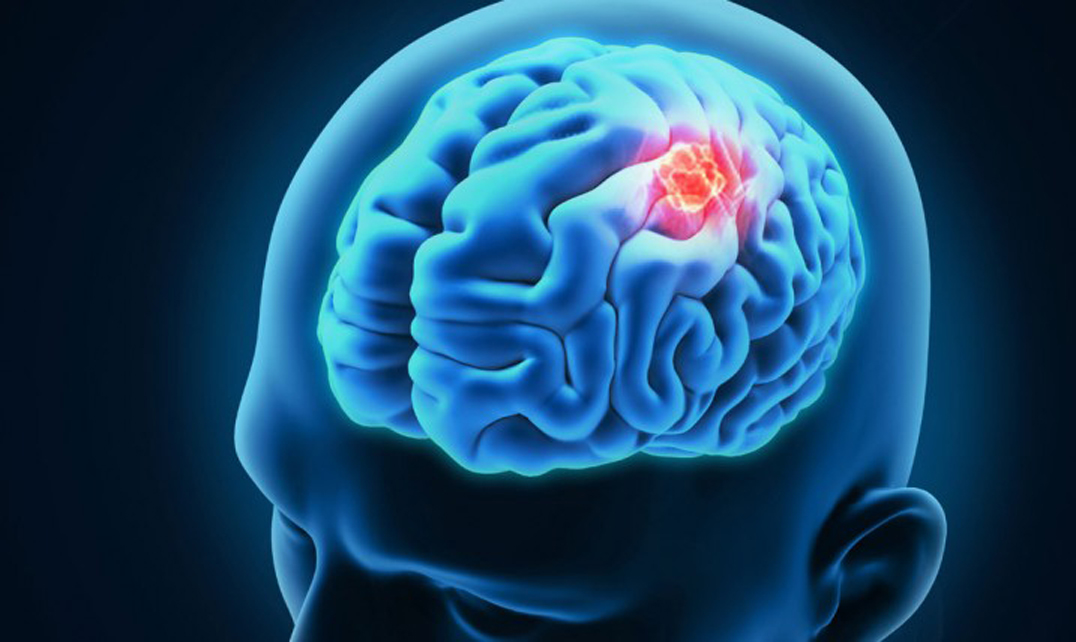 Brain Cancer The Causes And Treatments Moneyvest Brain Cancer The Causes And Treatments Moneyvest